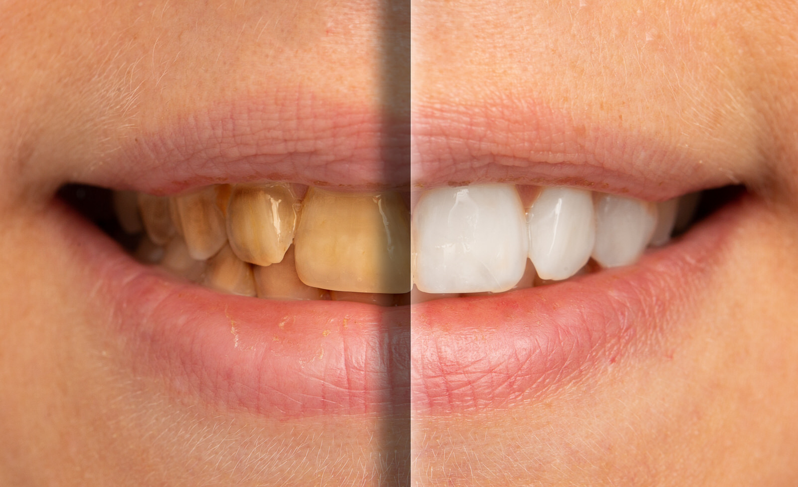 How Aging Affects Your Teeth Tips From Northgate Dental Northgate Dental
